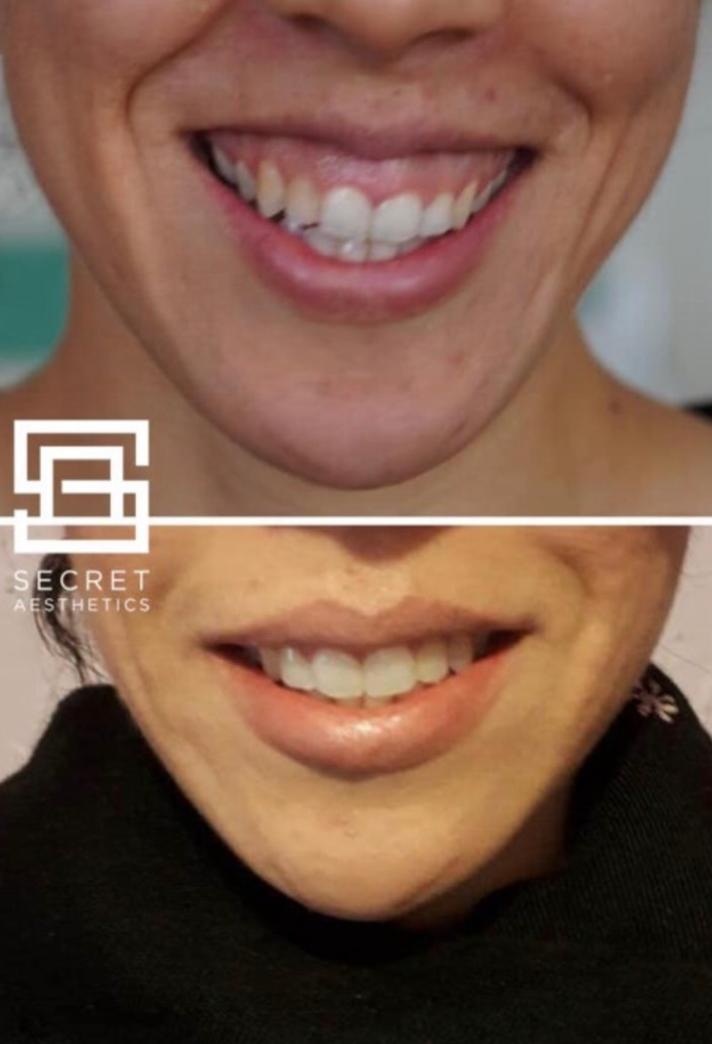Botox in Birmingham - Anti Wrinkle | Secret Aesthetics
